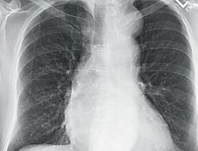 70-year-old patient with upper chest pain | Chest X-Ray interpretation