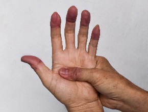 Cianosis - Para pacientes - Medicina Interna Basada en la Evidencia